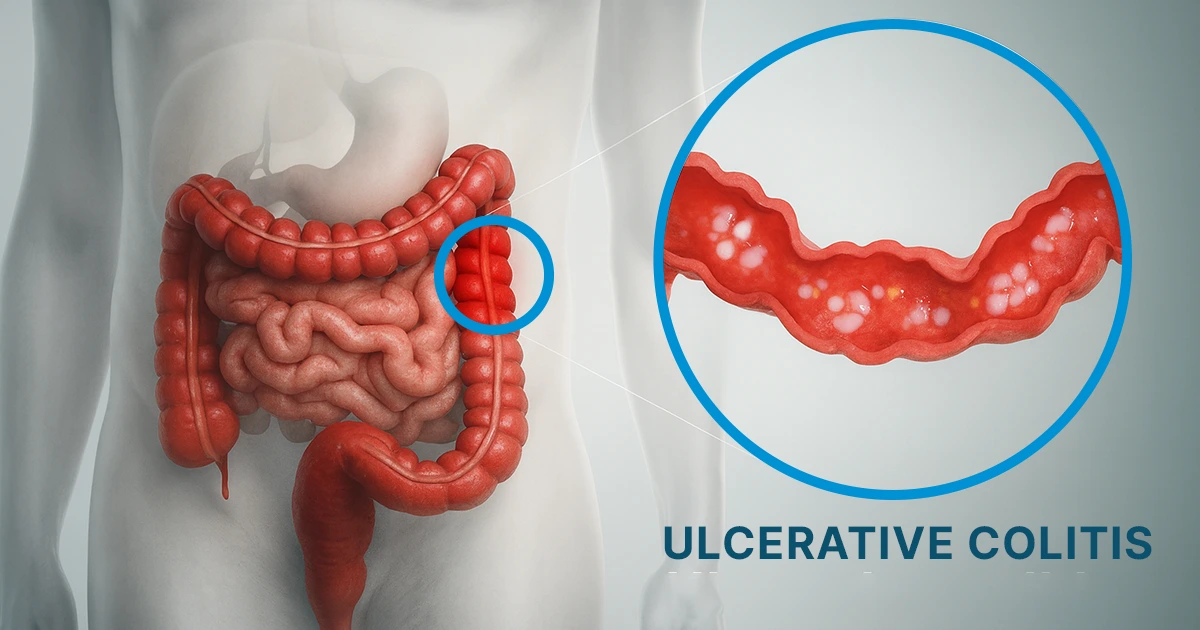 How to Treat Ulcerative Colitis for Lasting Relief